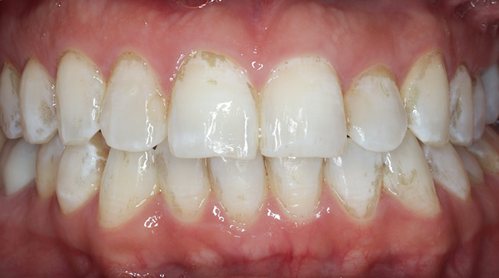 Whitening - SMILE PLAN Dental Clinic OSAKA